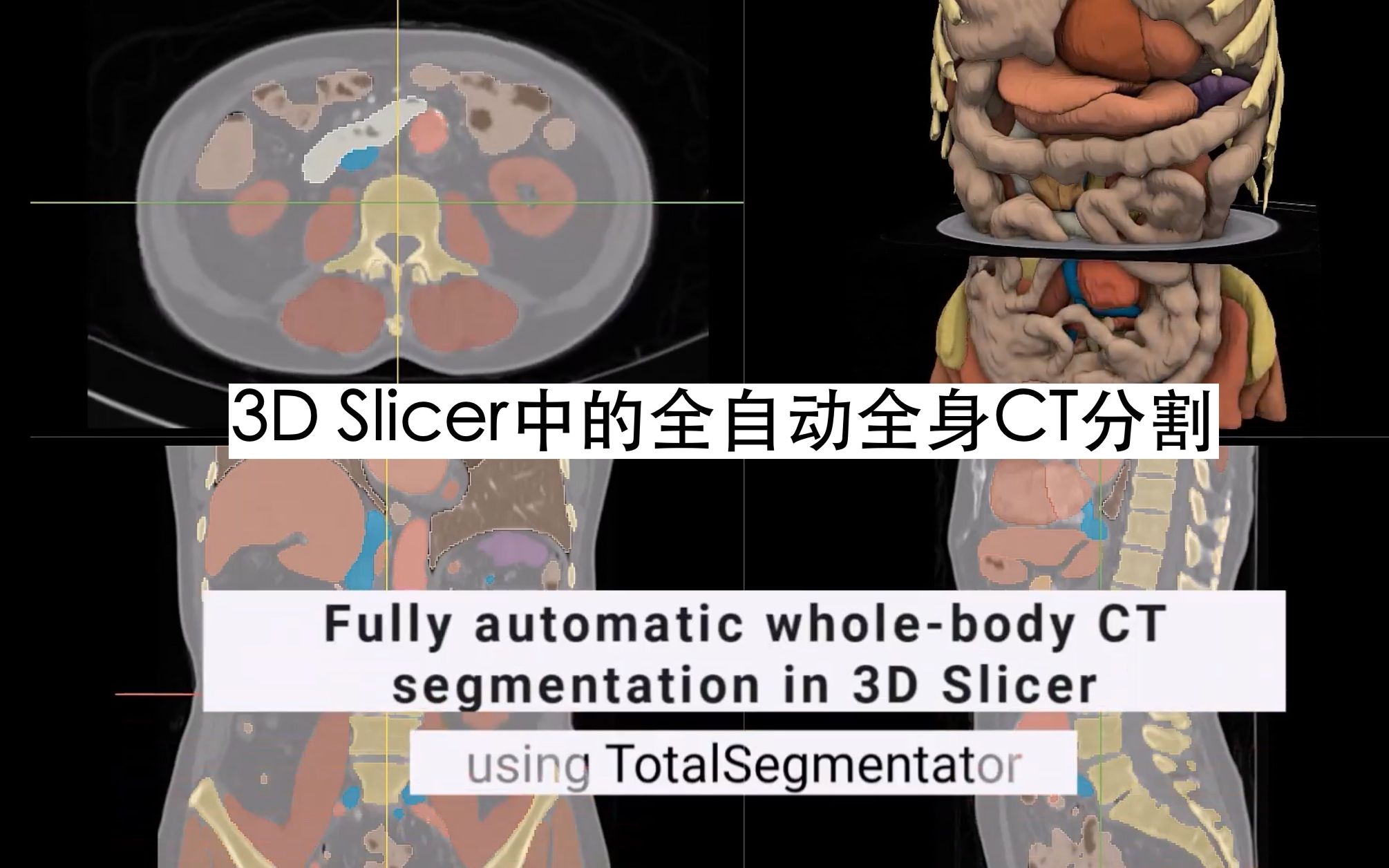 使用3DSlicer和TotalSegmentator在2分钟内自动进行全身CT分割-bilibili(B站)无水印视频解析——6li6在线工具箱