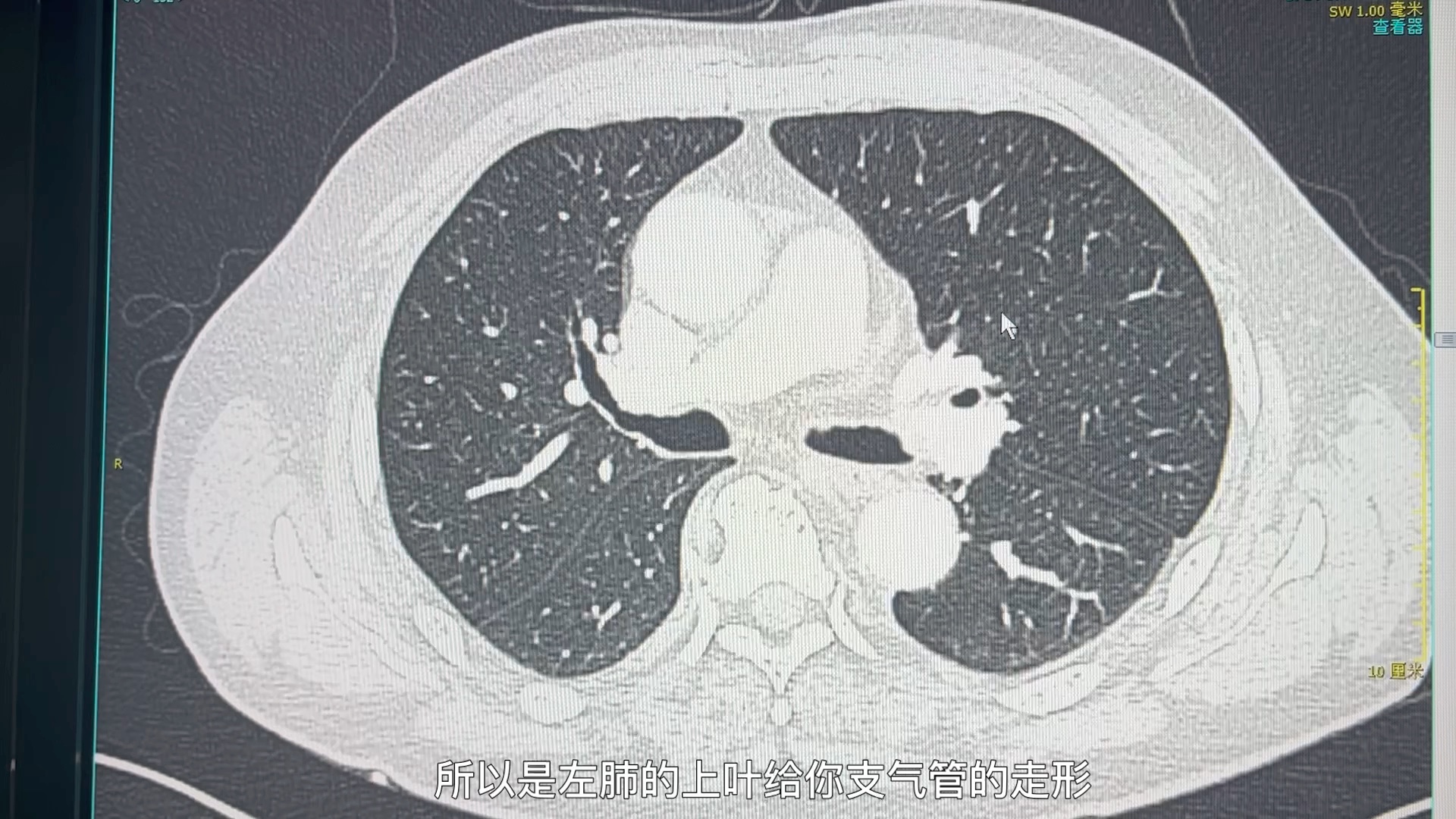 胸部CT 第二讲_哔哩哔哩_bilibili