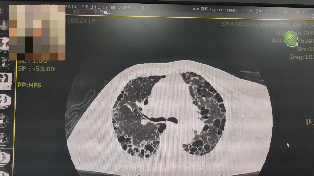 肺大泡CT影像_哔哩哔哩_bilibili