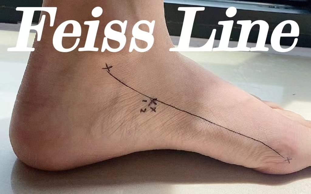 1分钟识别结构性/功能性扁平足：Feiss Line（需要笔和尺）_哔哩哔哩 (゜-゜)つロ 干杯~-bilibili