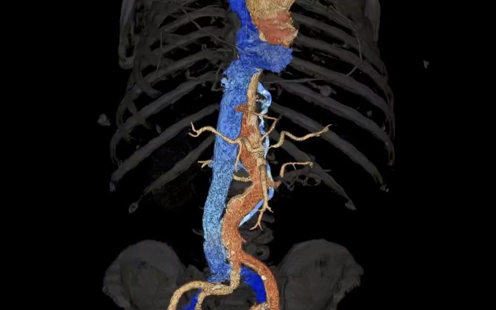 心脏大血管的CT三维重建_哔哩哔哩_bilibili