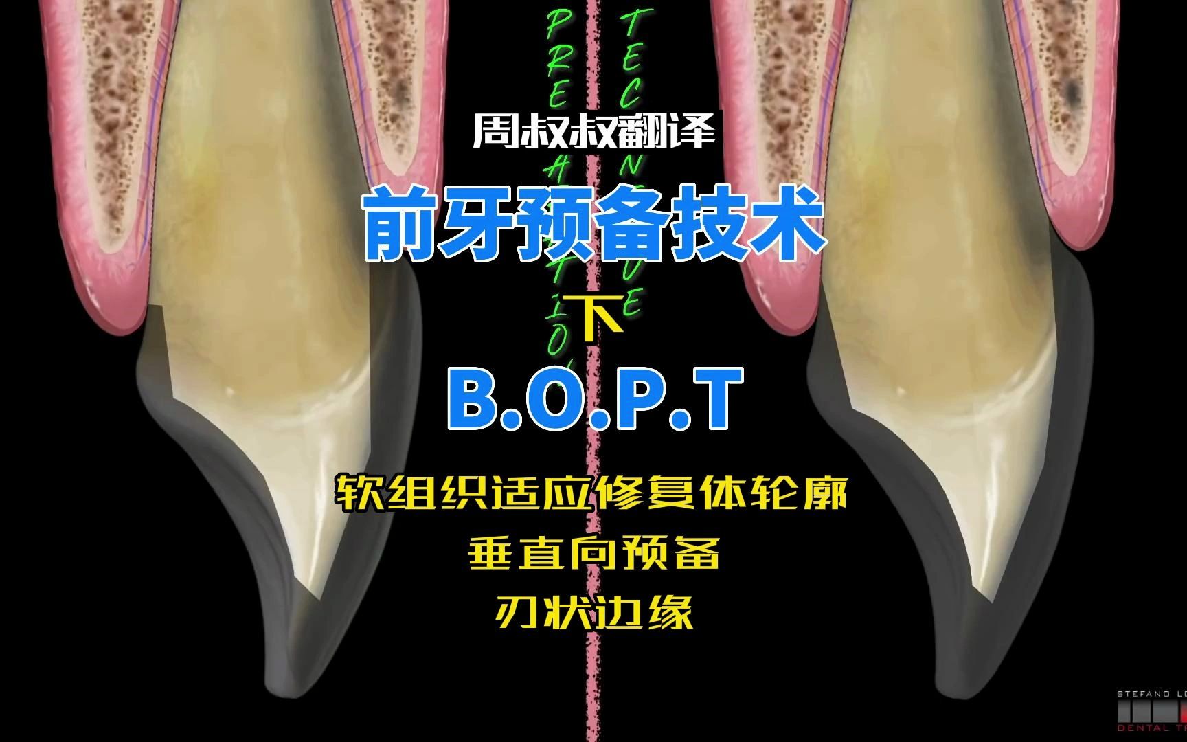 美学区全冠预备肩台 VS BOPT （下）-在北京看牙的周叔叔-在北京看牙的周叔叔-哔哩哔哩视频